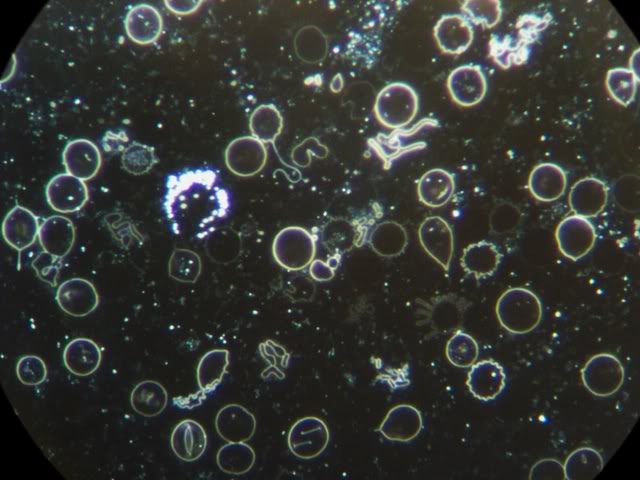 Lyme Disease | Biofilm Condition & Nervous System Effects