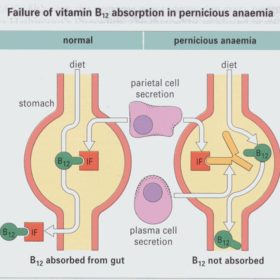 Intrinsic Factor Blocking Antibodies | Second Opinion Physician